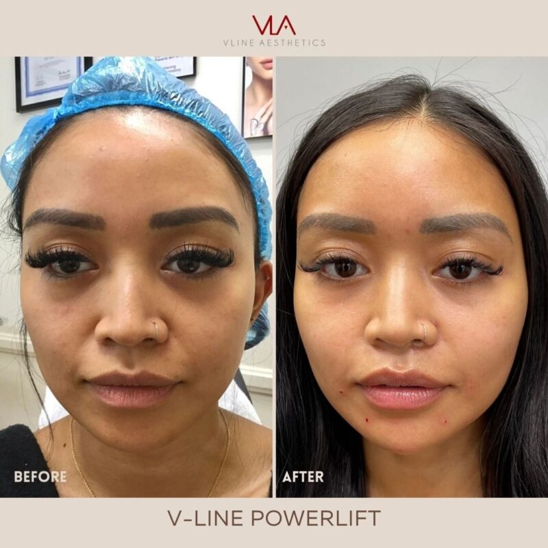 Non-surgical Face Lift - V LINE AESTHETICS