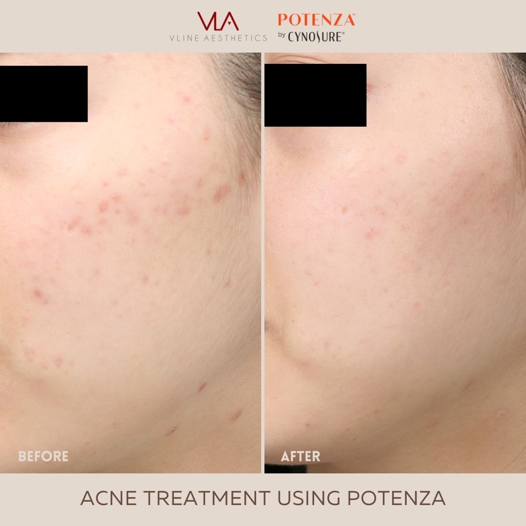 Microneedling - V LINE AESTHETICS