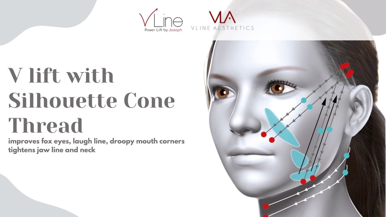 Silhouette Instalift - V LINE AESTHETICS