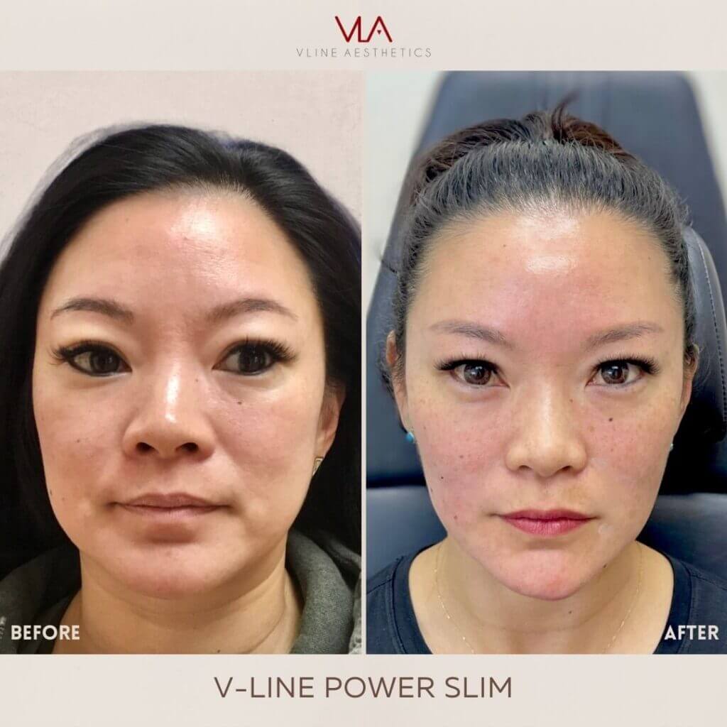 My Solutions - V LINE AESTHETICS