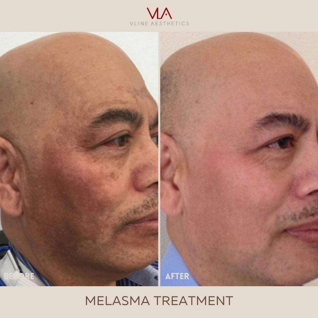 Melasma & PIH - V LINE AESTHETICS