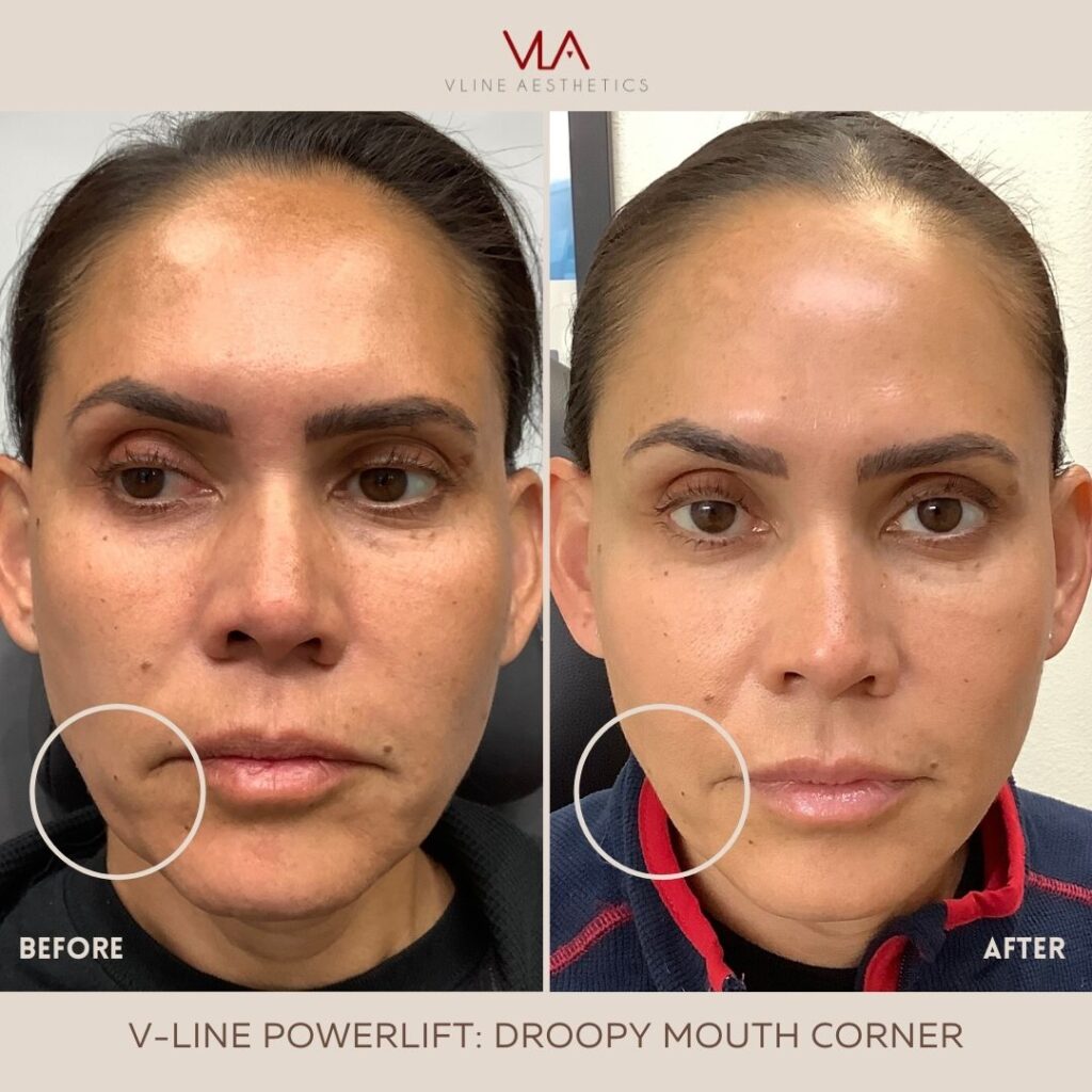 Droopy Mouth Corners - V LINE AESTHETICS