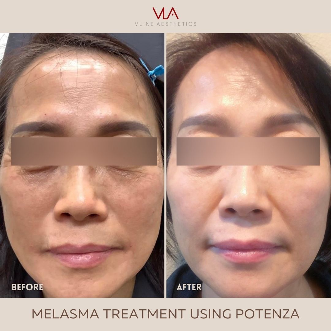 Melasma & PIH - V LINE AESTHETICS