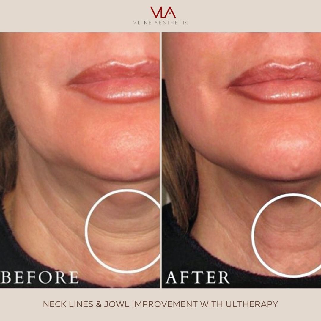 Ultherapy - V LINE AESTHETICS