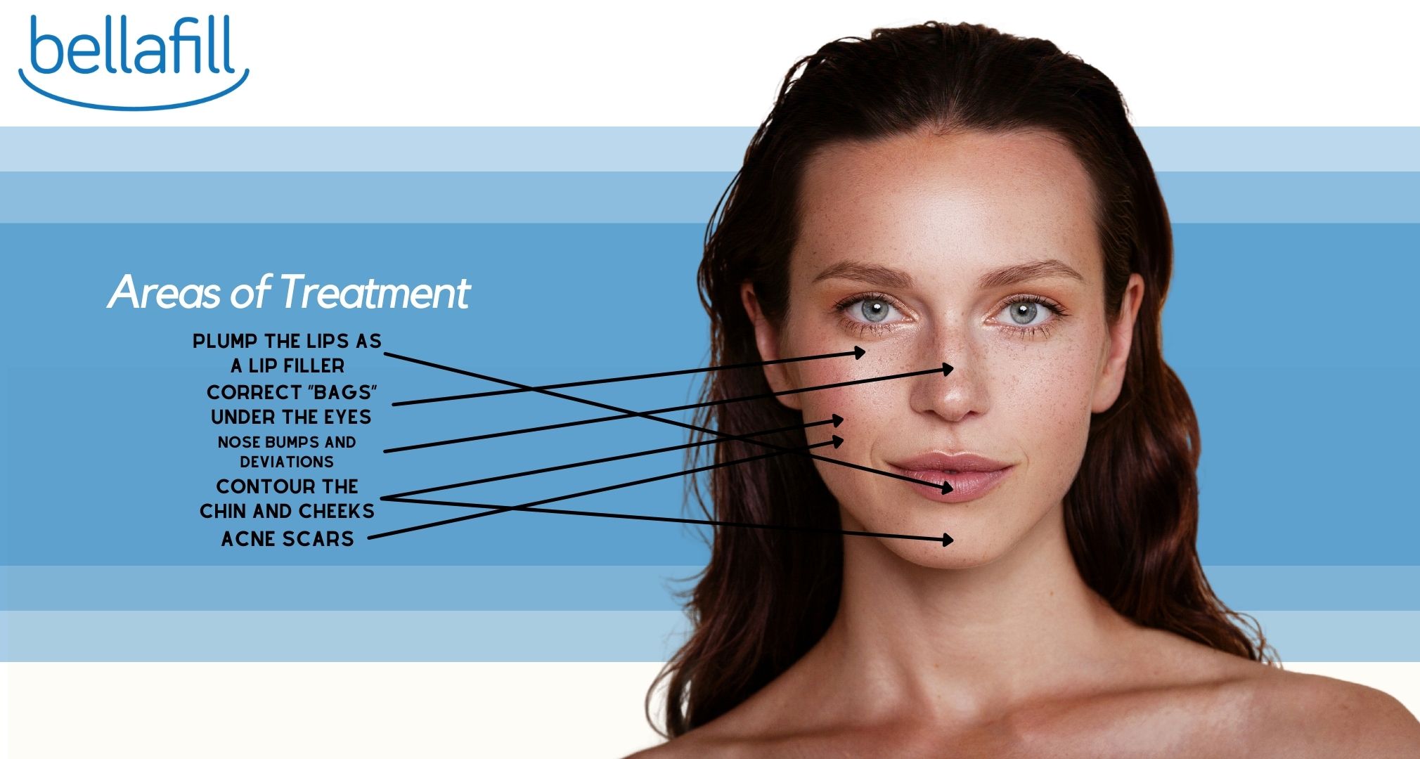 Bellafill - V LINE AESTHETICS