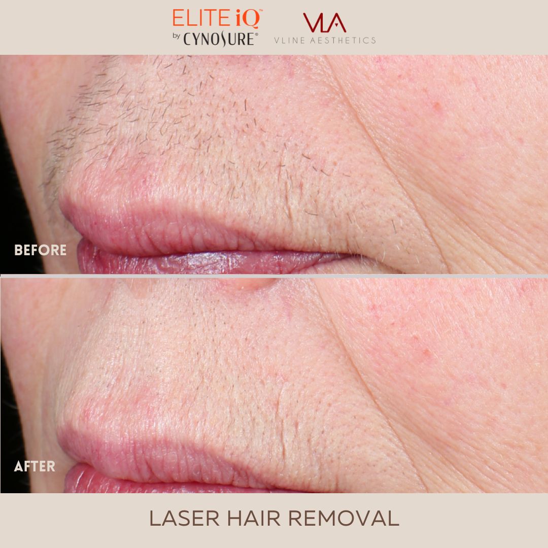 The Elite IQ Laser - V LINE AESTHETICS