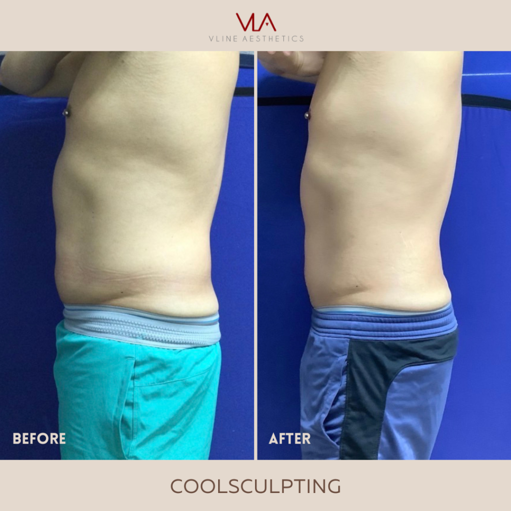 Men Treatments - V LINE AESTHETICS