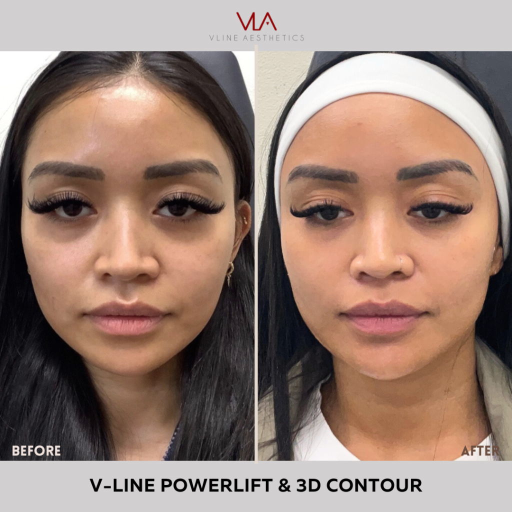 Jawline Lift - V LINE AESTHETICS